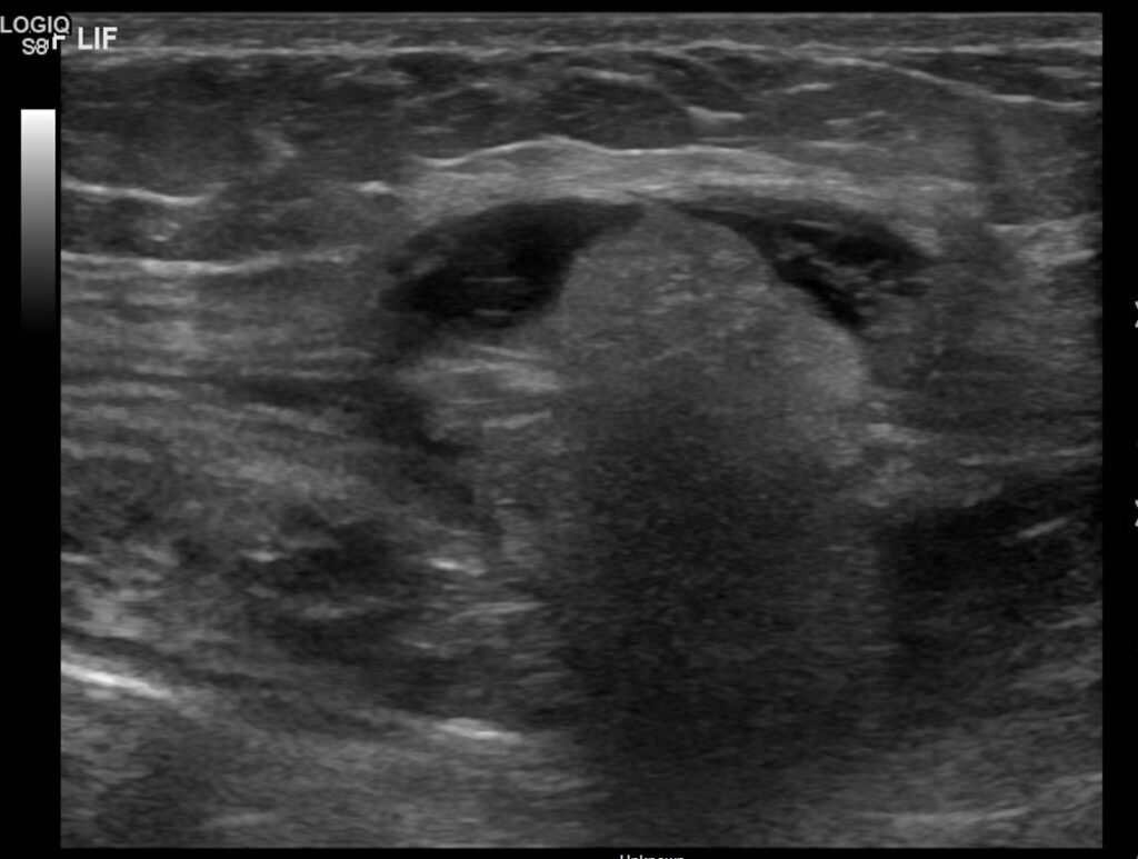 Post-laparoscopic Port Site Or Incisional Hernia » Sonohive