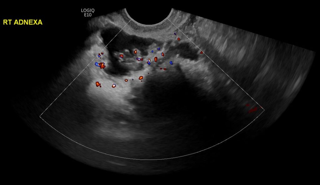 An Ovarian Tumour With An Initial Presentation Of RIF Pain » Sonohive