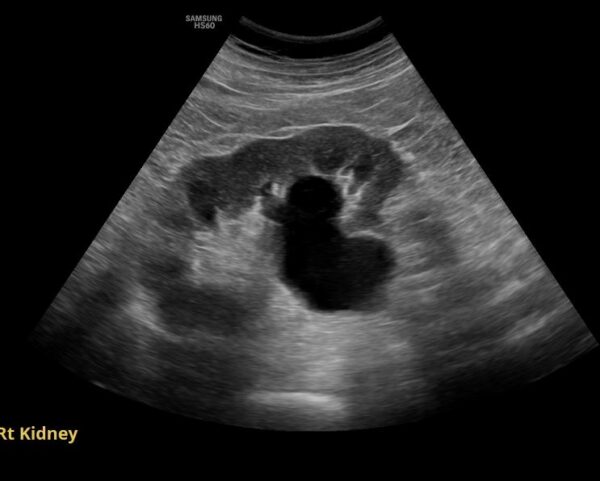 Parapelvic Simple Renal Cyst Mimicking Hydronephrosis On MRI » Sonohive