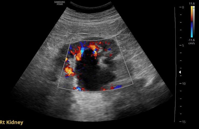 Parapelvic Simple Renal Cyst Mimicking Hydronephrosis On MRI » Sonohive