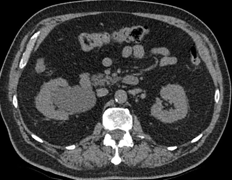Parapelvic Simple Renal Cyst Mimicking Hydronephrosis On MRI » Sonohive