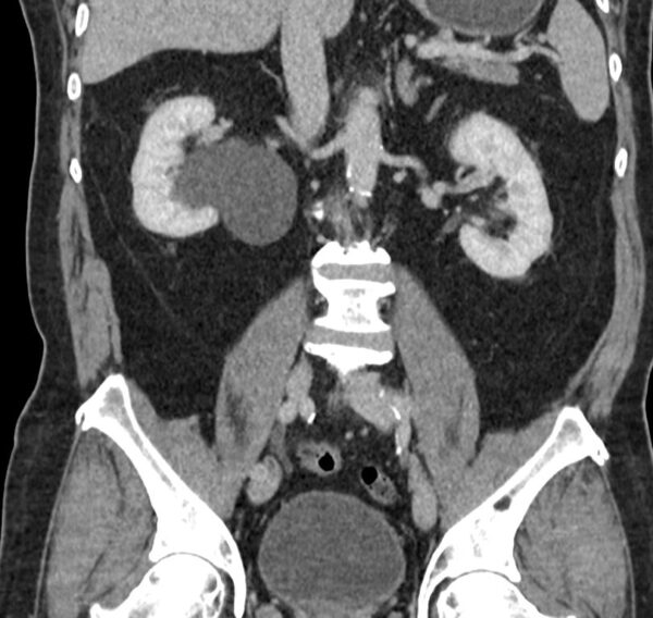 Parapelvic Simple Renal Cyst Mimicking Hydronephrosis On MRI » Sonohive