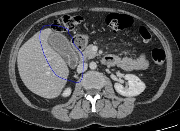 Ultrasound Diagnosed Gallstones That Were Radiolucent On A Recent CT ...