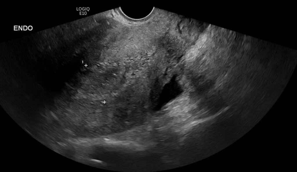 A Large Adnexal Mass In A Patient With Endometrial Cancer » Sonohive