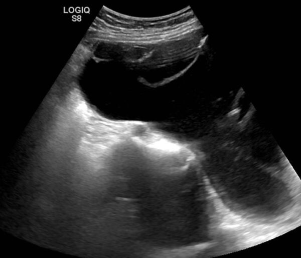 A Large Complex Ovarian Cyst Mimicking A Fibroid » Sonohive