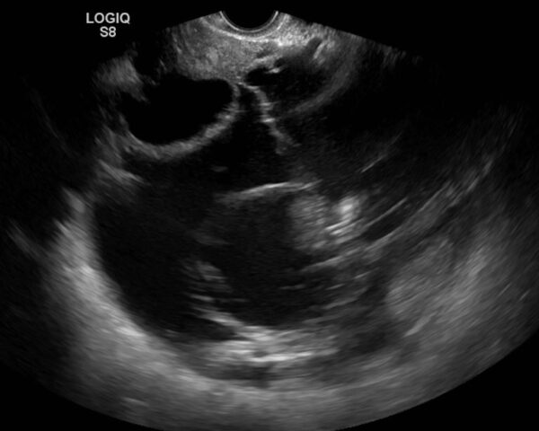 A Large Complex Ovarian Cyst Mimicking A Fibroid » Sonohive
