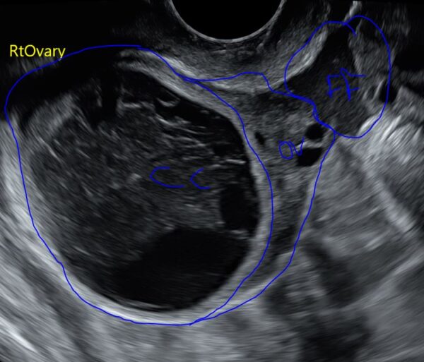 Haemorrhagic Cyst In A 26-year Old Female Presenting As Pelvic Pain ...