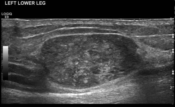 Lower Leg Soft Tissue Lesion With Concerning Ultrasound Features » Sonohive