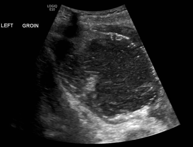 Left Groin Abscess » Sonohive