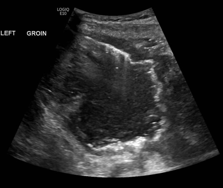 Left Groin Abscess – Sonohive