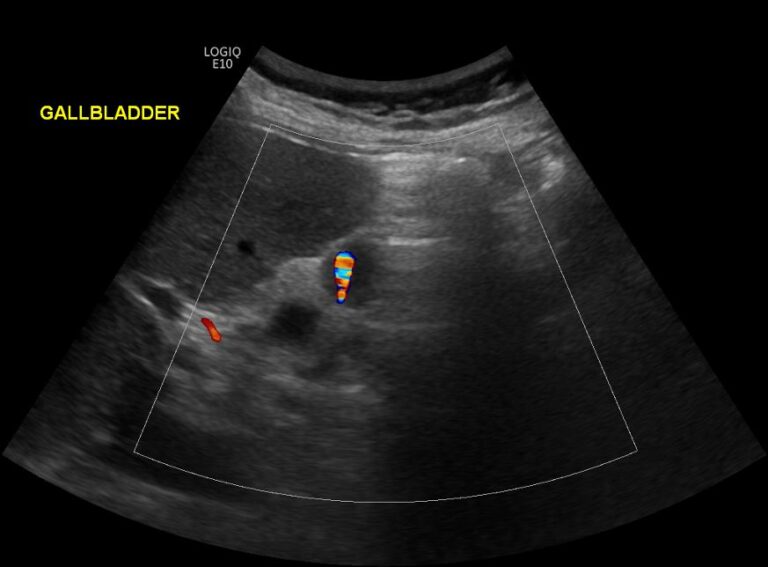 Figure Of 8 Gallbladder With A Focal Fundal Thickening » Sonohive