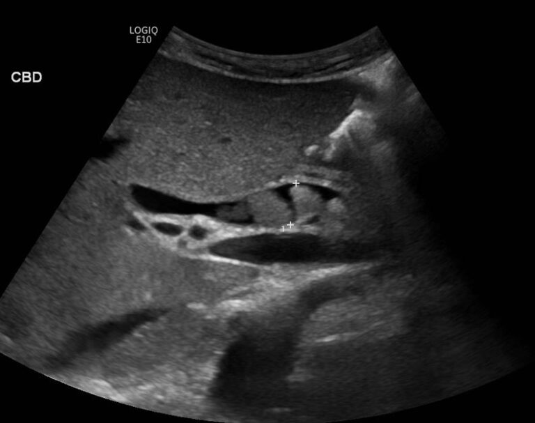 Multiple Biliary Calculi » Sonohive
