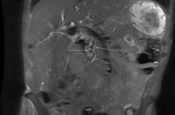 Multiple Biliary Calculi » Sonohive