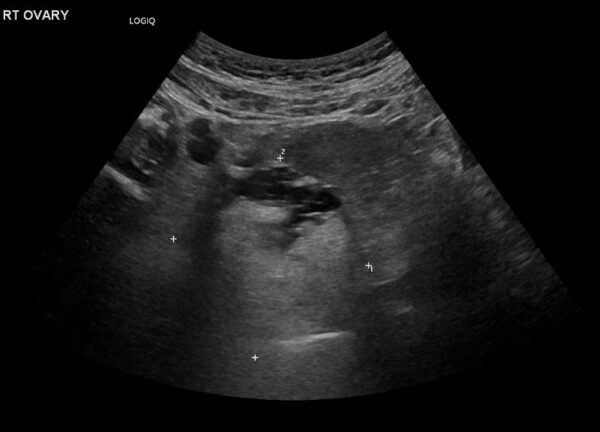 Dermoid Cyst » Sonohive