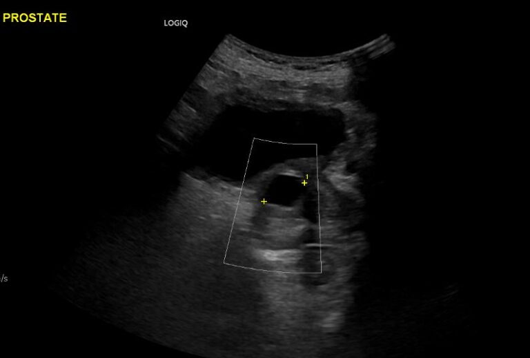 Bladder Diverticulum Coexisting with Bladder Wall Thickening and a ...