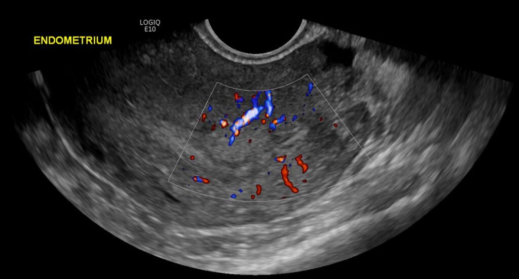 Endometrial Polyp Presenting As Painful Heavy Menstrual Bleeding » Sonohive