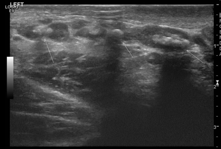 Incidental Calcifications Within The Ductus Deferens » Sonohive