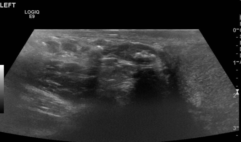 Incidental Calcifications Within The Ductus Deferens » Sonohive