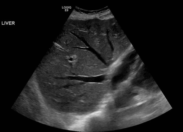 Normal Doppler Ultrasound Assessment Of A Transplant Liver » Sonohive