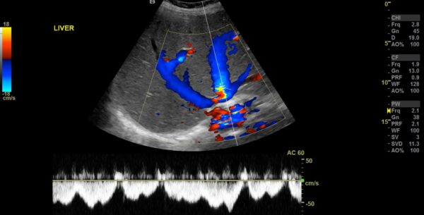 Normal Doppler Ultrasound Assessment Of A Transplant Liver » Sonohive