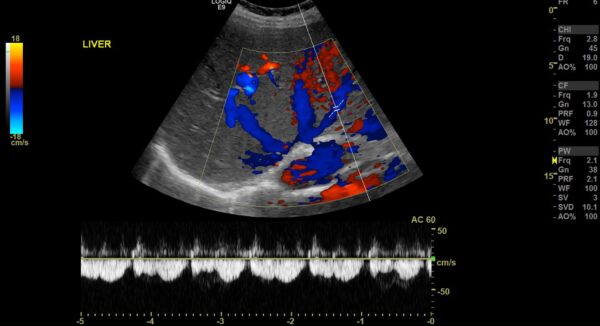 Normal Doppler Ultrasound Assessment Of A Transplant Liver » Sonohive